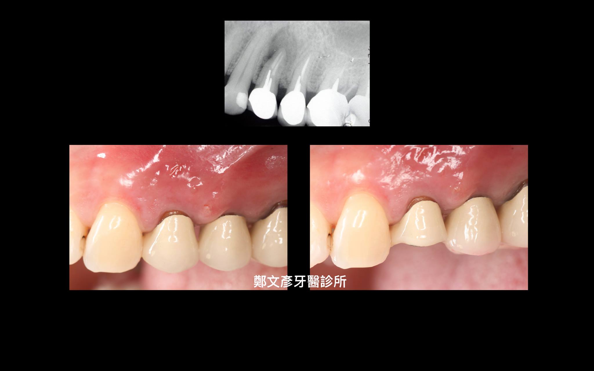 3. Role of granulation tissue in socket preservation - 鄭文彥牙醫診所的部落格 - udn部落格