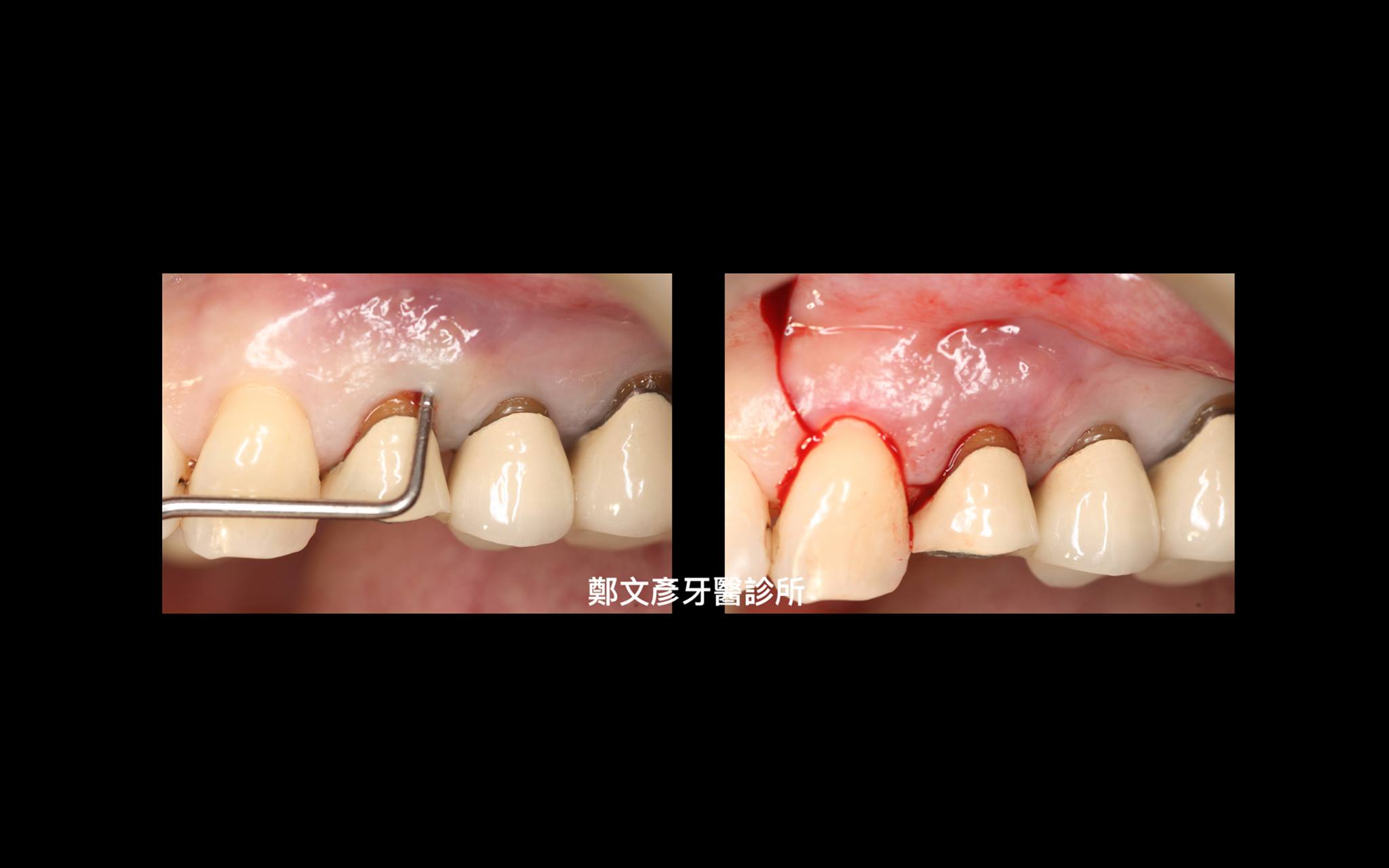 3. Role of granulation tissue in socket preservation - 鄭文彥牙醫診所的部落格 - udn部落格