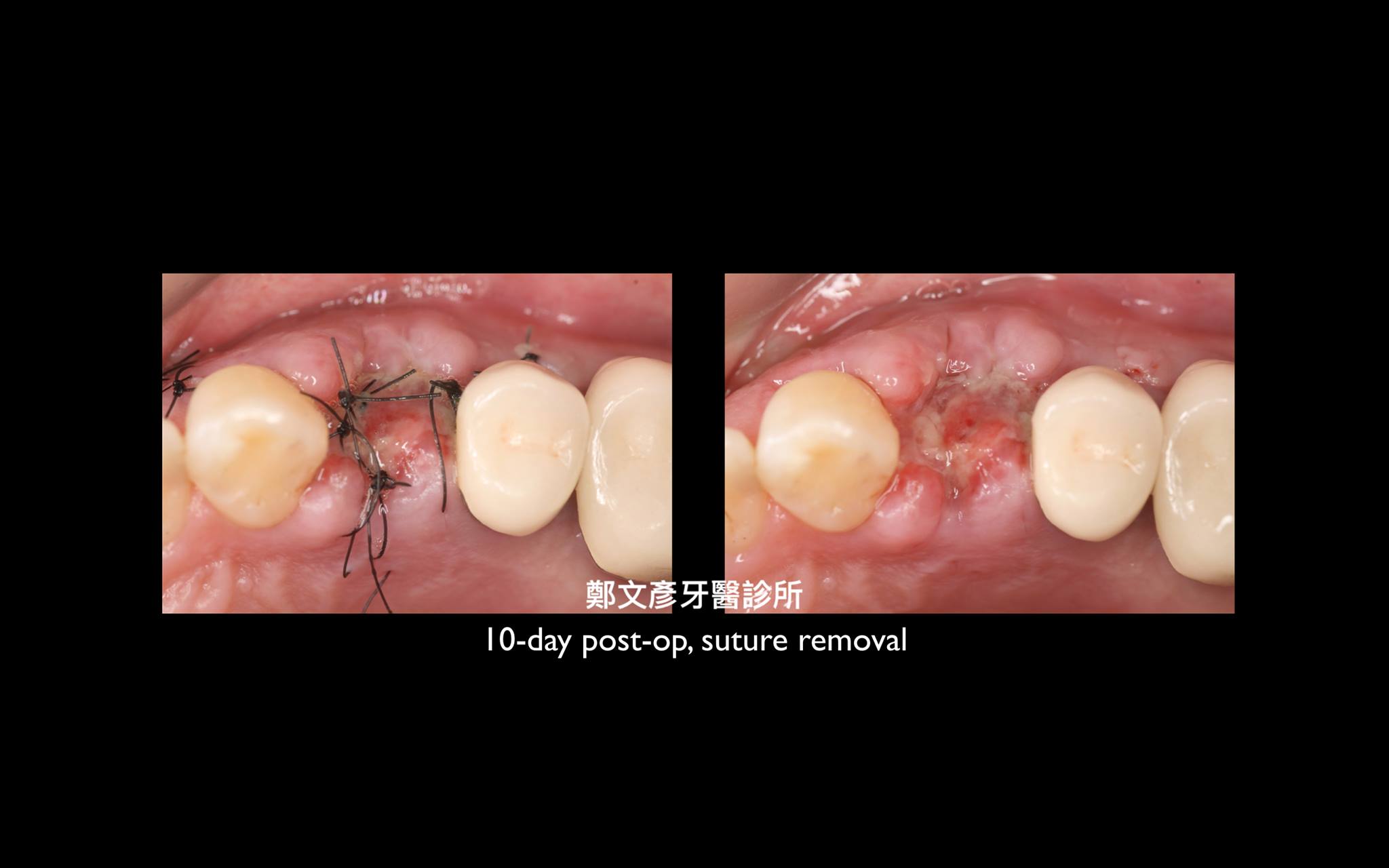 3. Role of granulation tissue in socket preservation - 鄭文彥牙醫診所的部落格 - udn部落格