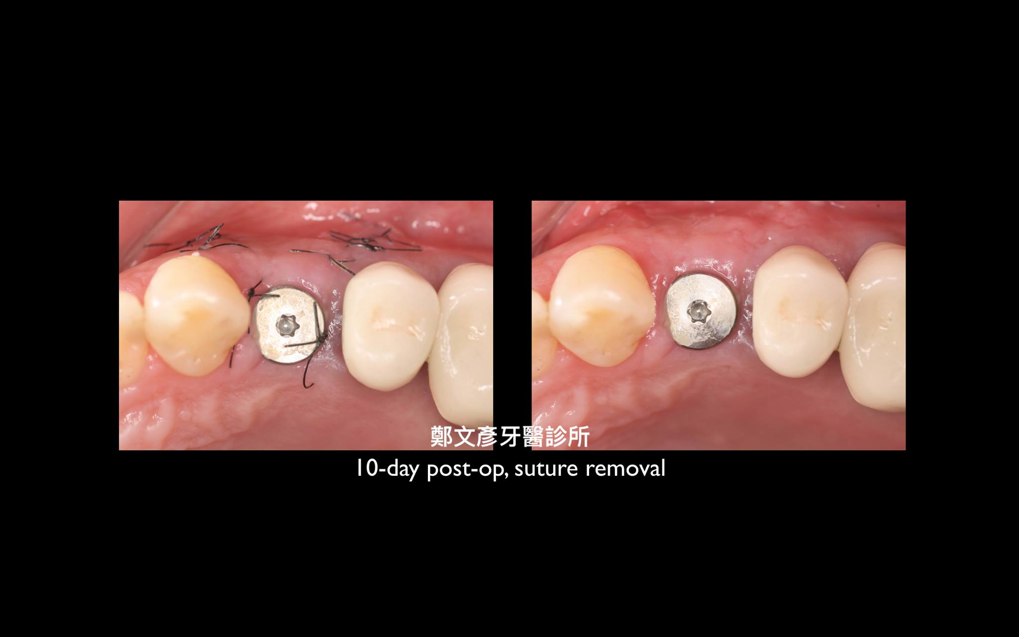 3. Role of granulation tissue in socket preservation - 鄭文彥牙醫診所的部落格 - udn部落格